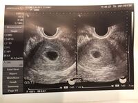 妊娠7w4dのものです。前回6w4dで胎芽3.7mm今回7.5mmで... - Yahoo!知恵袋