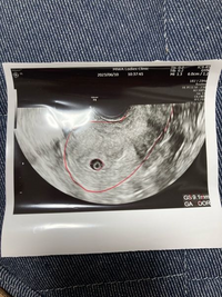 卵黄嚢が大きすぎるのではと思い質問します。6w5dのエコー写真です。3... - Yahoo!知恵袋