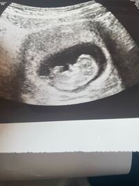 10w1dです。今日エコー写真を貰ってから気付いたんですけど... - Yahoo!知恵袋