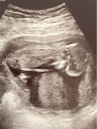 ベビーナブ詳しい方に質問です。今、13w4dですが、この子の性別がわか... - Yahoo!知恵袋