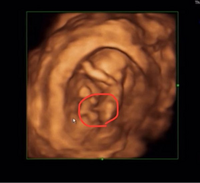 12w5dのエコー写真です。この写真に写ってるシュッとしたも... - Yahoo!知恵袋