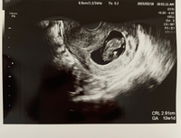 現在10w1dの妊婦です。本日検診でのエコー画像です。大きさ... - Yahoo!知恵袋