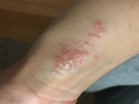 手首が昨日の朝から痒く、、じんましん、しっしんでしょうか？水... - Yahoo!知恵袋