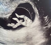 11w5dのエコー写真です。この写真では男の子か女の子かどち... - Yahoo!知恵袋