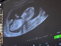 ベビーナブわかる方いますか？13w4dのエコー写真です！性別... - Yahoo!知恵袋