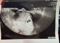 卵黄嚢が大きすぎるのではと思い質問します。6w5dのエコー写真です。3... - Yahoo!知恵袋