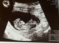 これは11w3dの時のエコー写真です。ダウン症などの特徴はあ... - Yahoo!知恵袋