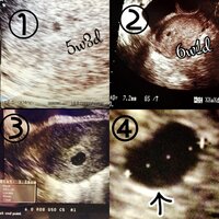 5w3dで胎嚢確認後、7w3dで心拍、卵黄、確認出来ず流産の可... - Yahoo!知恵袋