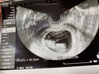 現在11w3dなのですが - ネットでエコー写真を見てダウン症... - Yahoo!知恵袋