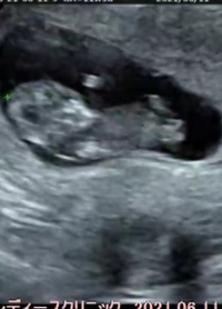 こんばんは。11w5dの検診の際に撮ったエコー写真です。この写... - Yahoo!知恵袋