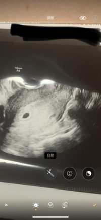 体外受精で陽性判定出ました。ホルモン補充なので確実に5w3dです。胎嚢の... - Yahoo!知恵袋