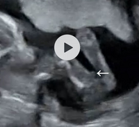 16w6dの時のエコーです。足と足の間に映ってる矢印の丸いのなんだと思い... - Yahoo!知恵袋