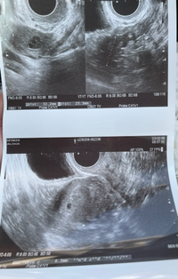 エコーの見方を教えて下さい。先週5w3dで胎嚢確認してもらいました。した... - Yahoo!知恵袋
