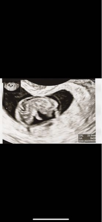 胎児のNTについてです。2週間前(9W2D)でのエコーで先生には何も言わ... - Yahoo!知恵袋