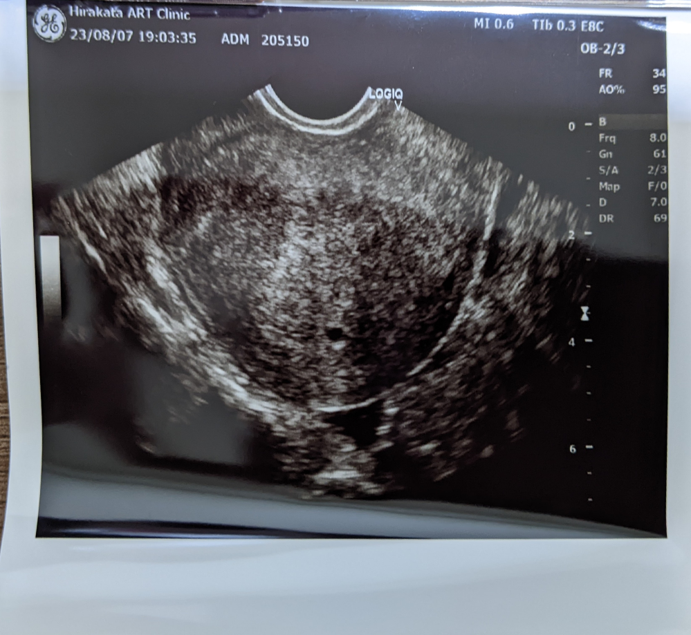 胚盤胞移植しました。BT8で妊娠検査薬が陽性。BT9で血中hcgが104.7... - Yahoo!知恵袋