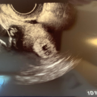 35歳、体外受精の凍結胚盤胞移植で妊娠しました。今日は5w5dだったので... - Yahoo!知恵袋