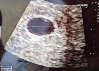 7w4dで胎嚢の中がからっぽでした。4日後に再度内診をして、何も見えなけ... - Yahoo!知恵袋