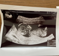 エコー写真の首のむくみ(NT)について13w1dのエコー写真な... - Yahoo!知恵袋