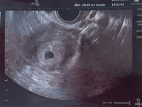 妊娠検査薬陽性後、5w3dのエコーです！胎嚢ではないと言われ、... - Yahoo!知恵袋