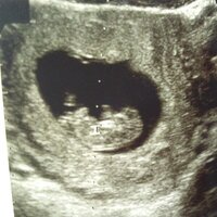 9w5dエコー写真。手足が見えない！！ - 先日9w5dになり... - Yahoo!知恵袋