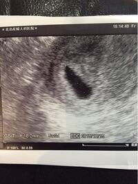 5w3dと言われますした。 - 胎芽が見えないように感じて不安で... - Yahoo!知恵袋