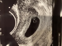 7w5dで流産と診断されました。6w5dで胎芽も心拍も見えず諦め... - Yahoo!知恵袋