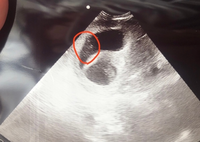 エコー写真を見ていただきたいです。7w4dで双子だと判明したのですが、その... - Yahoo!知恵袋