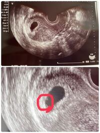 最終月経開始日が4/7で、 - それから数えると現在10w1dに... - Yahoo!知恵袋