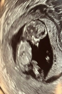 11w5dのエコー写真です性別がわかるのはまだまだだと思いながら... - Yahoo!知恵袋