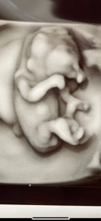 12w5dです。この突起物は男の子のシンボルと考えていいでしょうか。先生に... - Yahoo!知恵袋