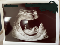 ベビーナブわかる方いらっしゃいますか？11w5dのエコーです。ナブが写って... - Yahoo!知恵袋