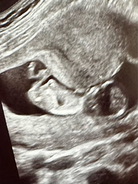 ベビーナブ、わかる方よろしくお願いします！12w5dのエコー写真... - Yahoo!知恵袋