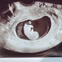 9w5dのエコー画像について順調のようなのですが、胎嚢内左側に見える白いモヤ... - Yahoo!知恵袋