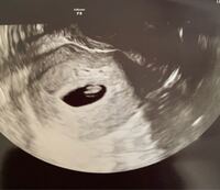 7週エコー写真あります - 本日7w0dで受診して、胎芽8.9で心拍数143... - Yahoo!知恵袋