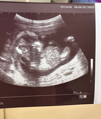 14w5dのエコーです気になったのですが、赤ちゃんまん丸すぎませんか？なんか... - Yahoo!知恵袋