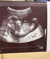 このエコーを見て何か変な所とかありますか？首の後ろむくみなど。14w5dって... - Yahoo!知恵袋