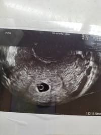 6w5dの初診エコーです。胎嚢11.9mm、胎芽と心拍はもう少しで... - Yahoo!知恵袋