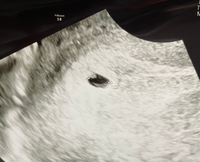 5w3dで病院へ行きました。胎嚢が5.7mmしかなかったのですが、... - Yahoo!知恵袋