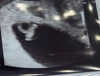 胎児の大きさと計り方について。6w5dの妊婦です。顕微授精で授かり... - Yahoo!知恵袋