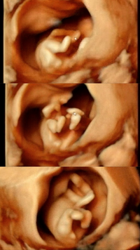 13w4dの4Dのエコーで性別の判断は難しいと思うのですが…もし似たようなエ... - Yahoo!知恵袋