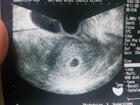 今日で6w5dの主婦です。前回の検診は4w2dでその時胎嚢が12.3... - Yahoo!知恵袋