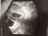 最終生理から数えて7w0dで2回目の受診で撮ったエコーです1週間前6... - Yahoo!知恵袋