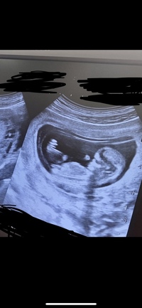 12w5dのエコー写真になります。CRL5.3cmでした。この2本に... - Yahoo!知恵袋