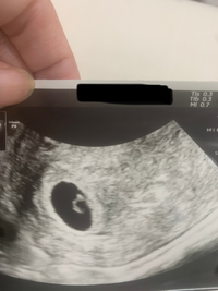 6w5dです。これは胎芽が見えるのでしょうか？ - Yahoo!知恵袋