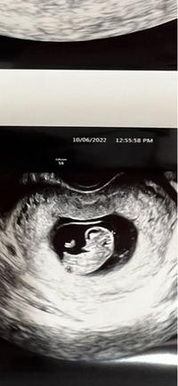 このとんがっている部分はベビーナブでしょうか？9w5dのエコーです！ - Yahoo!知恵袋