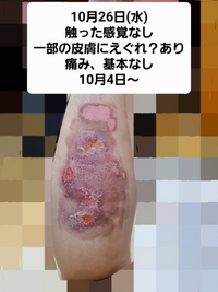 これは潰瘍というものですか？https://detail.chieb... - Yahoo!知恵袋