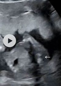 意見聞かせてください16w6dの時のエコー動画を見返しているときには気になるも... - Yahoo!知恵袋