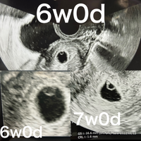 妊娠7週で心拍が消えました。初めての妊娠で6w0dで心拍確認し、2回目の心拍確... - Yahoo!知恵袋