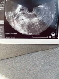 本日で5w3dなのですが、胎嚢は7.5mmでした。卵黄嚢すら確認でき... - Yahoo!知恵袋
