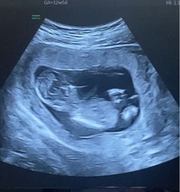 12w5d妊婦ですこのエコー写真でダウン症の可能性があるかどうか分か... - Yahoo!知恵袋